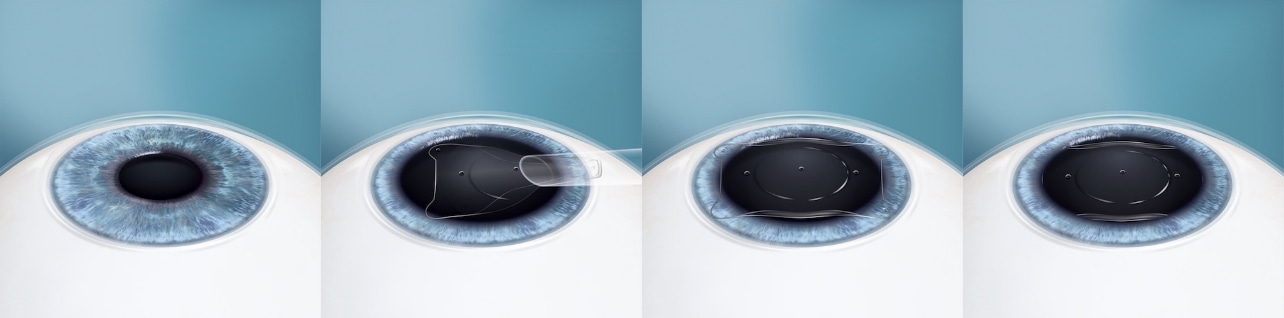 EVO ICL Near Me in Milwaukee and Wauwatosa WI